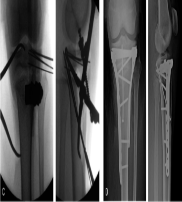 News - Bicondylar tibial plateau fracture with hyperextension and varus（1）