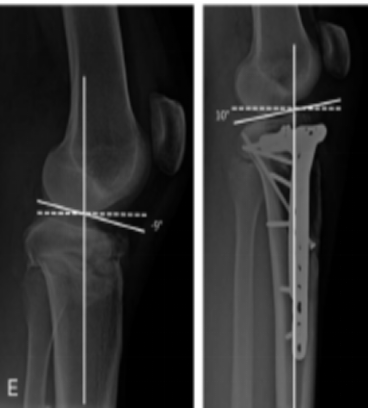 News - Bicondylar tibial plateau fracture with hyperextension and varus（1）