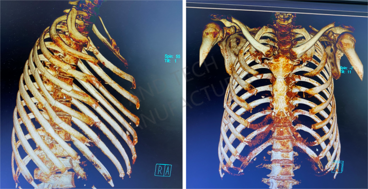 News - Rib Fracture Case Sharing- Rib Plate System