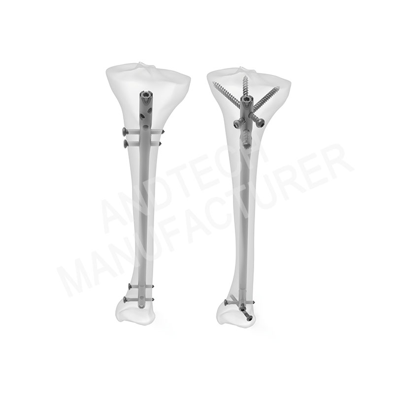 China Tibia Intramedullary Nail System Manufacturer and Supplier | AND